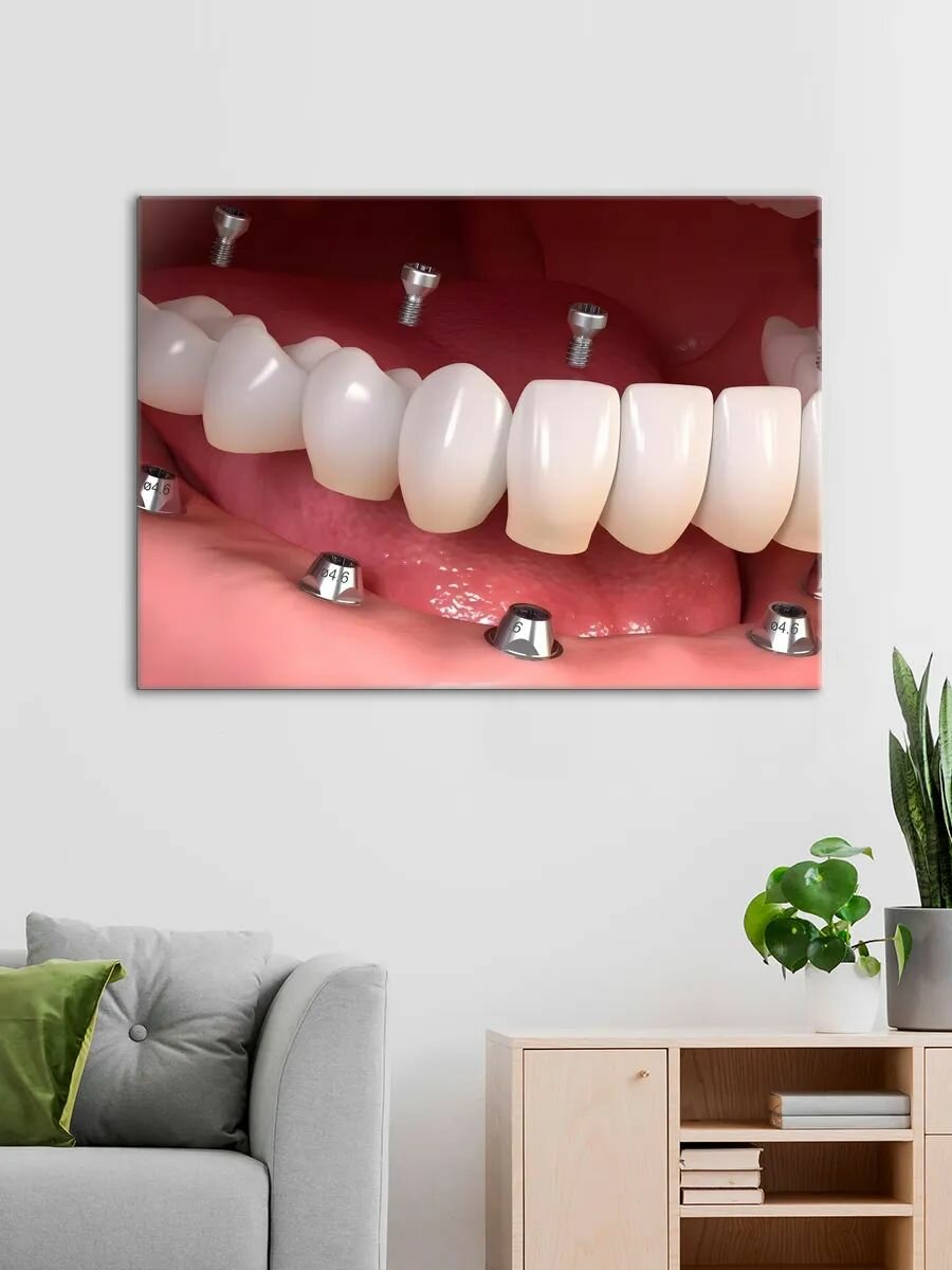 Картина на стену "Зубные импланты", 70х50 см