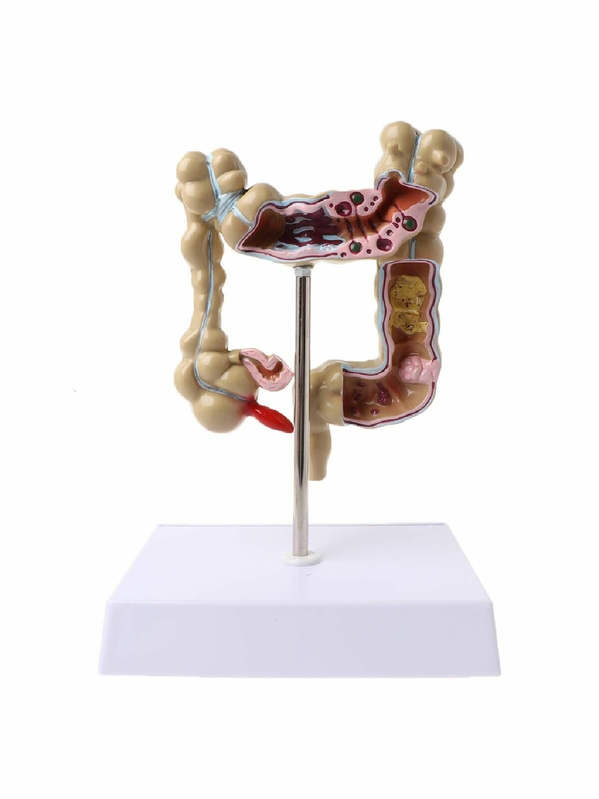 Модель поражения толстой кишки человека