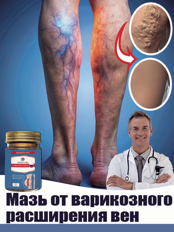 Мазь для лечения варикозного расширения вен ног, подходит для лечения отеков и тяжести в ногах, сосудистой сеточки, тромбов, 50 г.