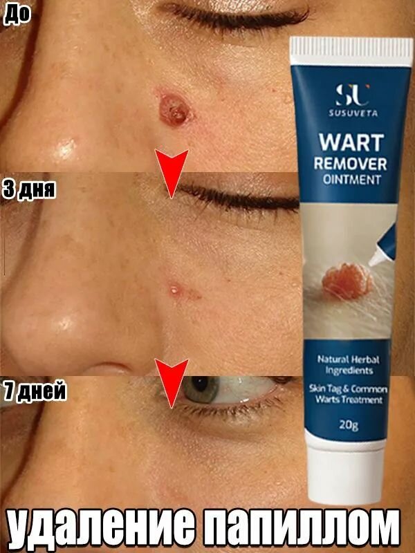 SUSUVETA / Мазь от бородавок, Крем средство для удаления бородавок, папиллом и родинок, безболезненно, не оставляет следов без побочных эффектов / 20г