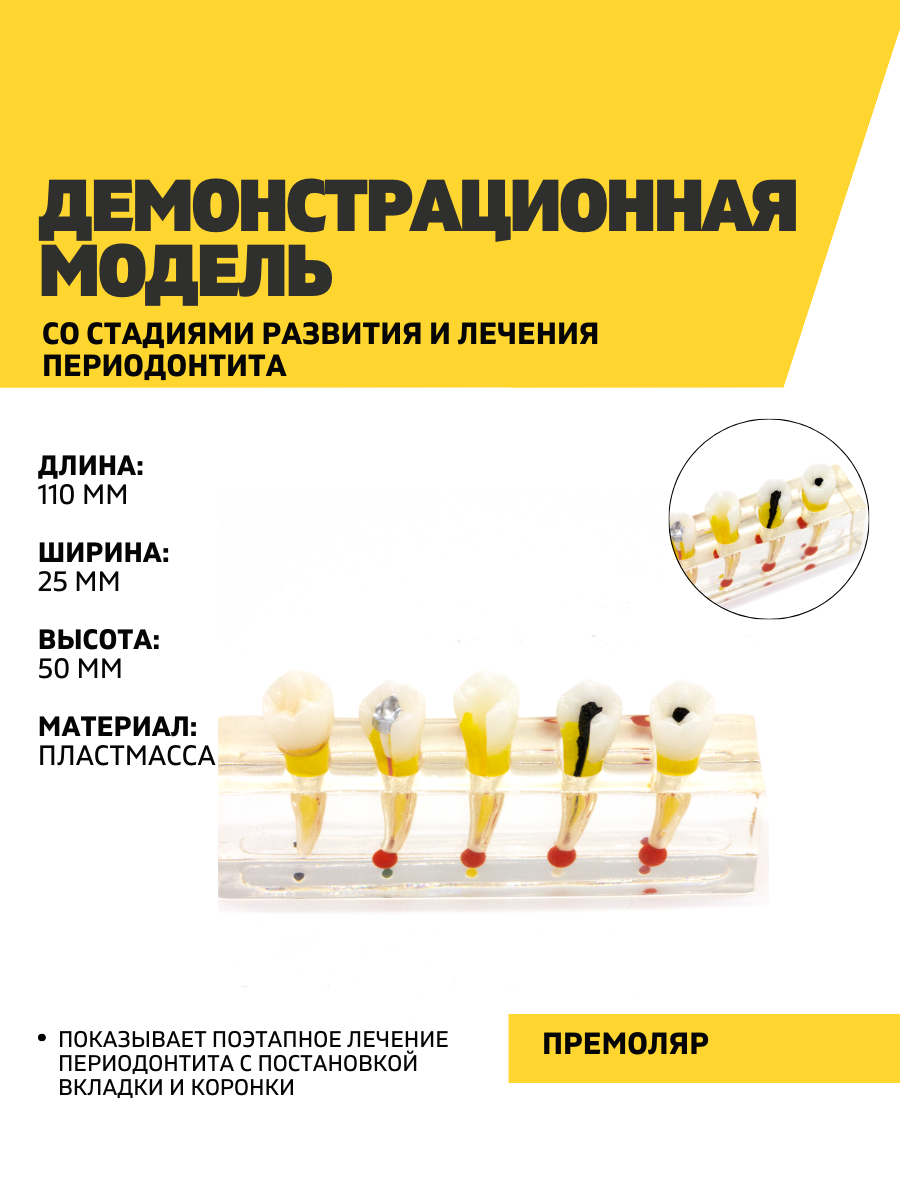 Демонстрационная модель со стадиями развития и лечения периодонтита премоляра