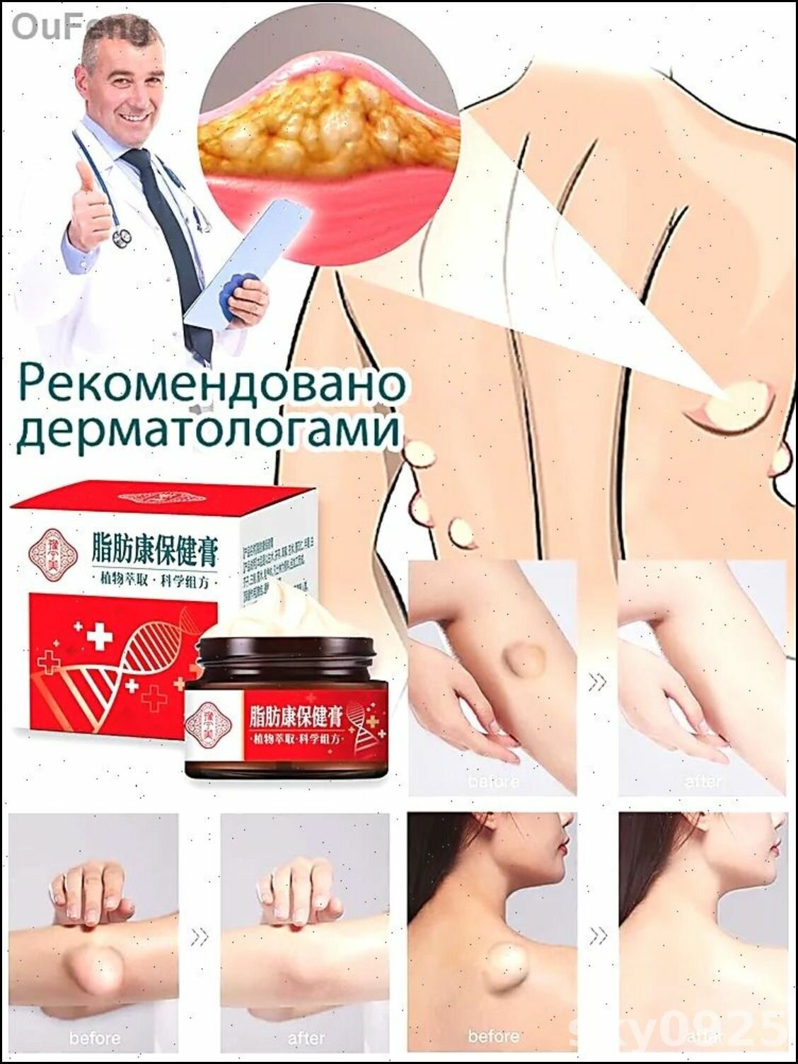 Мазь от липомы, Быстрое и безопасное удаление жировиков, обезболивающий,30 г