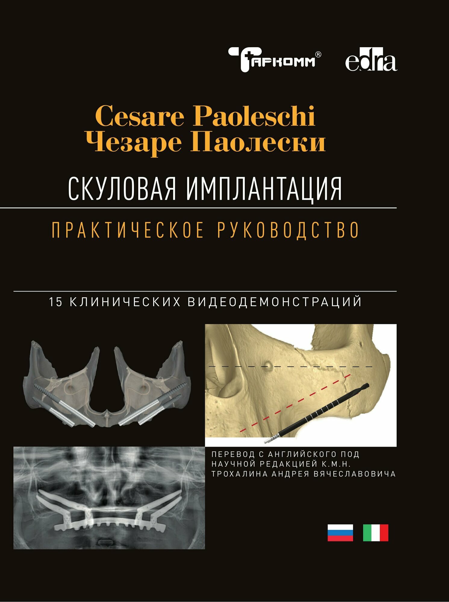 Скуловая имплантация. Практическое руководство