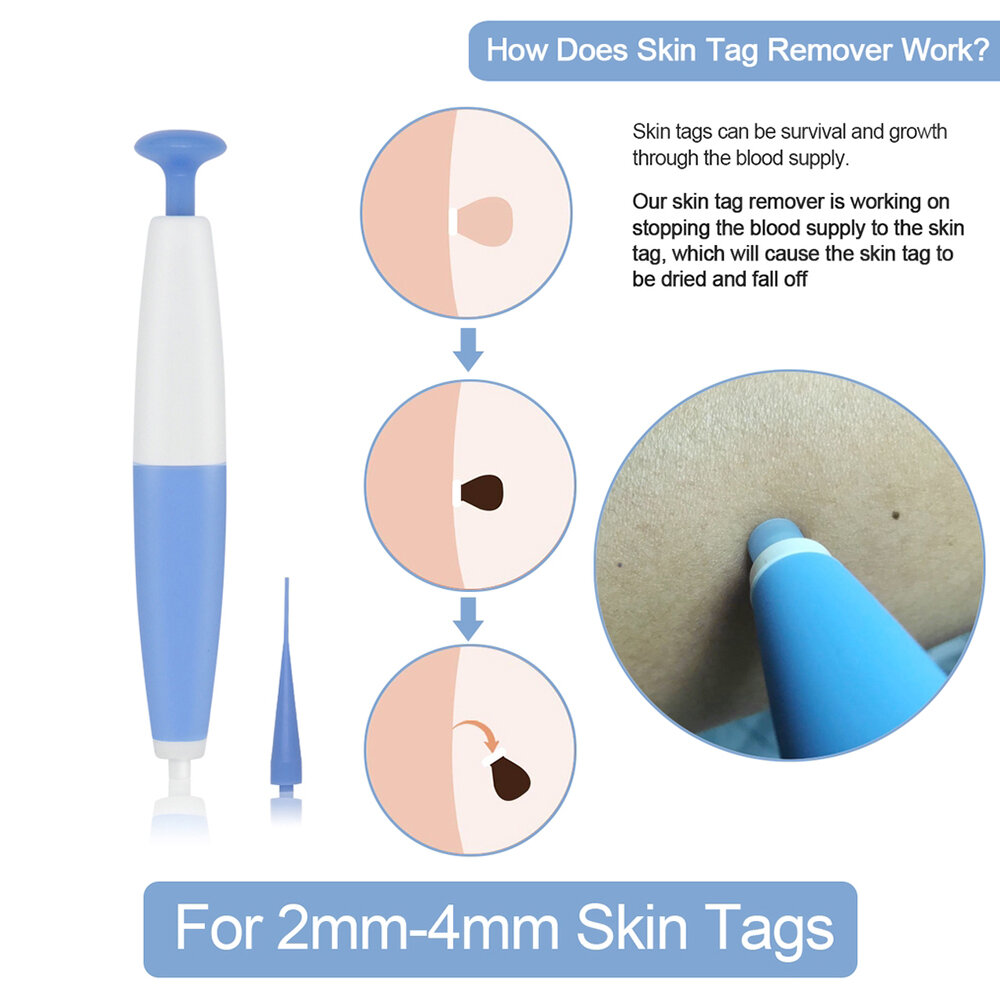 Инструмент для удаления папиллом, невусов, мозолей, бородавок, папиллом, кожных наростов, 2 мм, уход за лицом