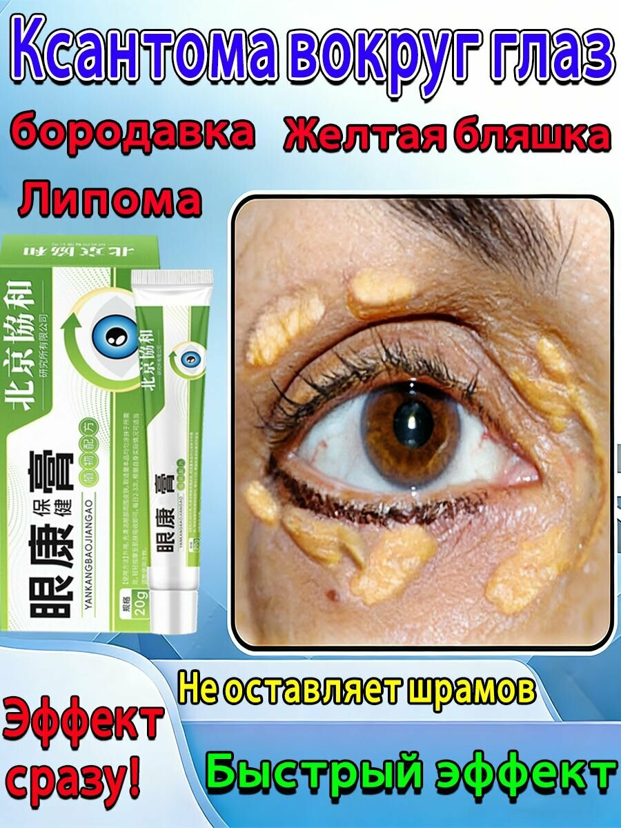 Крем для ухода за глазами, используемый для удаления ксантомы, бородавок, дегенерации желтого пятна и пигментных пятен вокруг глаз, не оставляя шрамов.
