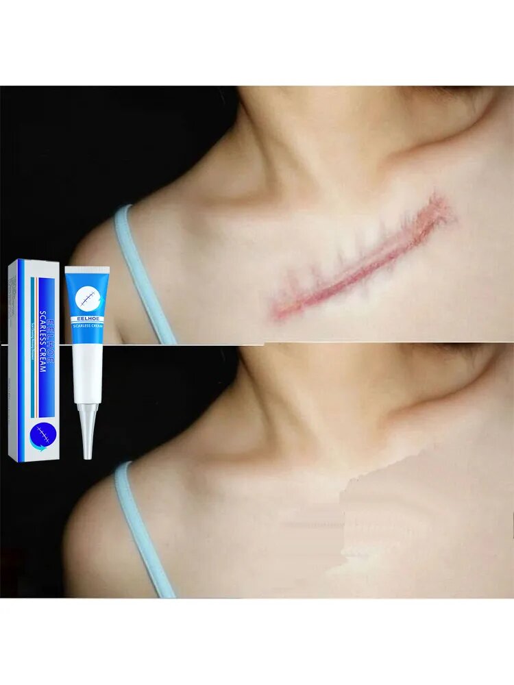 Крем Контрактубекс для восстановления кожи: эффективное средство от шрамов, растяжек и ожогов, нежный уход за кожей.