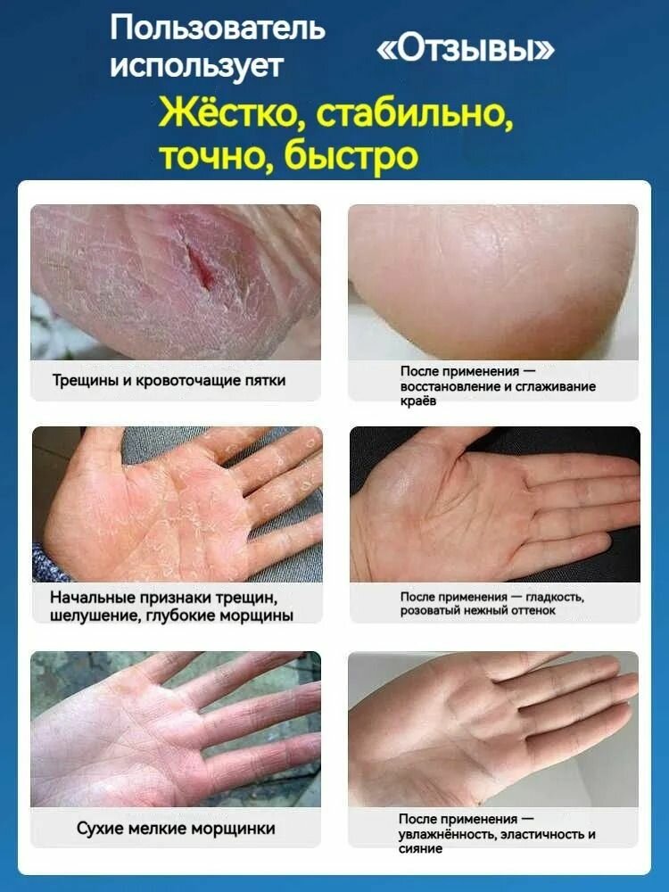 Мазь от обморожения для рук, ног, носа и ушей, восстановление после обморожения, быстрое заживление, устранение покраснений, зуда, трещин, быстрый эффект, 20 грамм