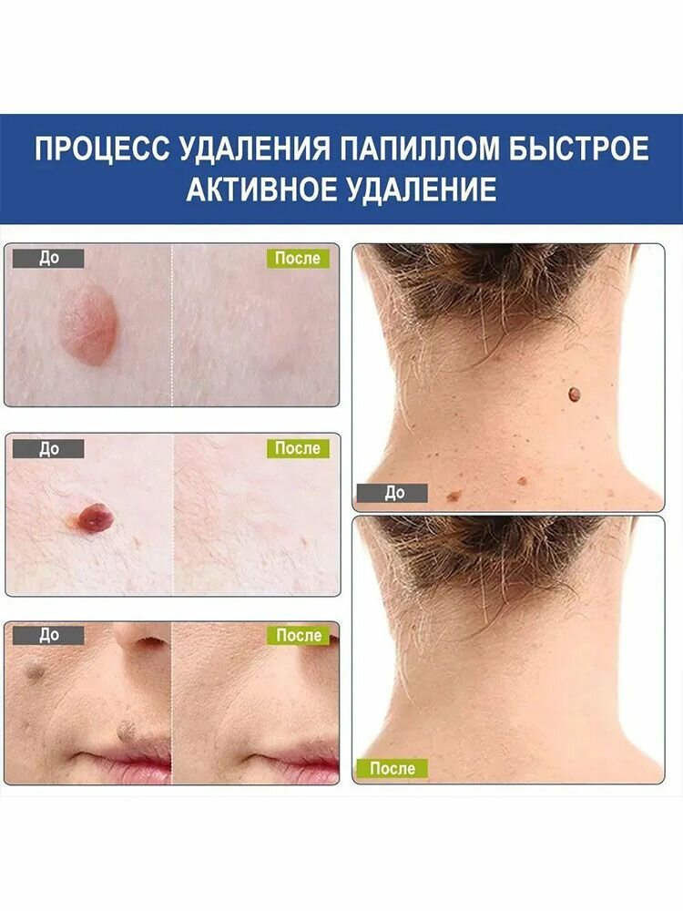 Средство от папиллом и бородавок средство