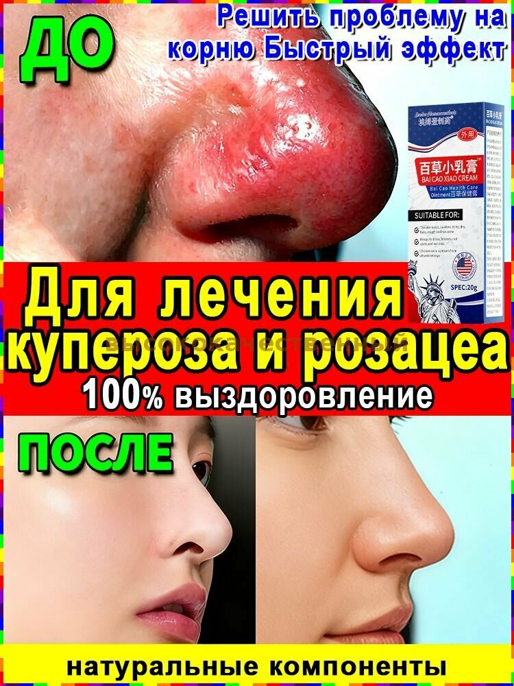 Крем для ухода за чувствительной кожей с признаками розацеа, укрепляет капилляры, снижает воспаление и раздражение, обеспечивает длительное успокоение 20 г