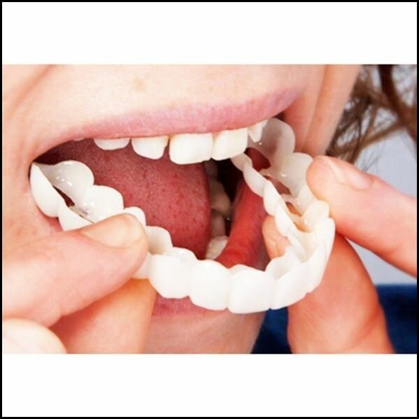 Эксклюзивные косметические виниры верхние, временная зубная конструкция в количестве 1 шт