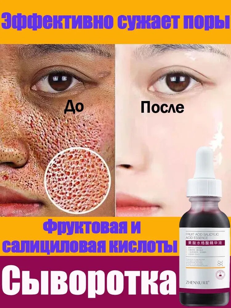 Сыворотка для лица с кислотами, восстановление водного баланса, контроль себума, постакне и воспалений, oчищает и сужает поры 30 мл