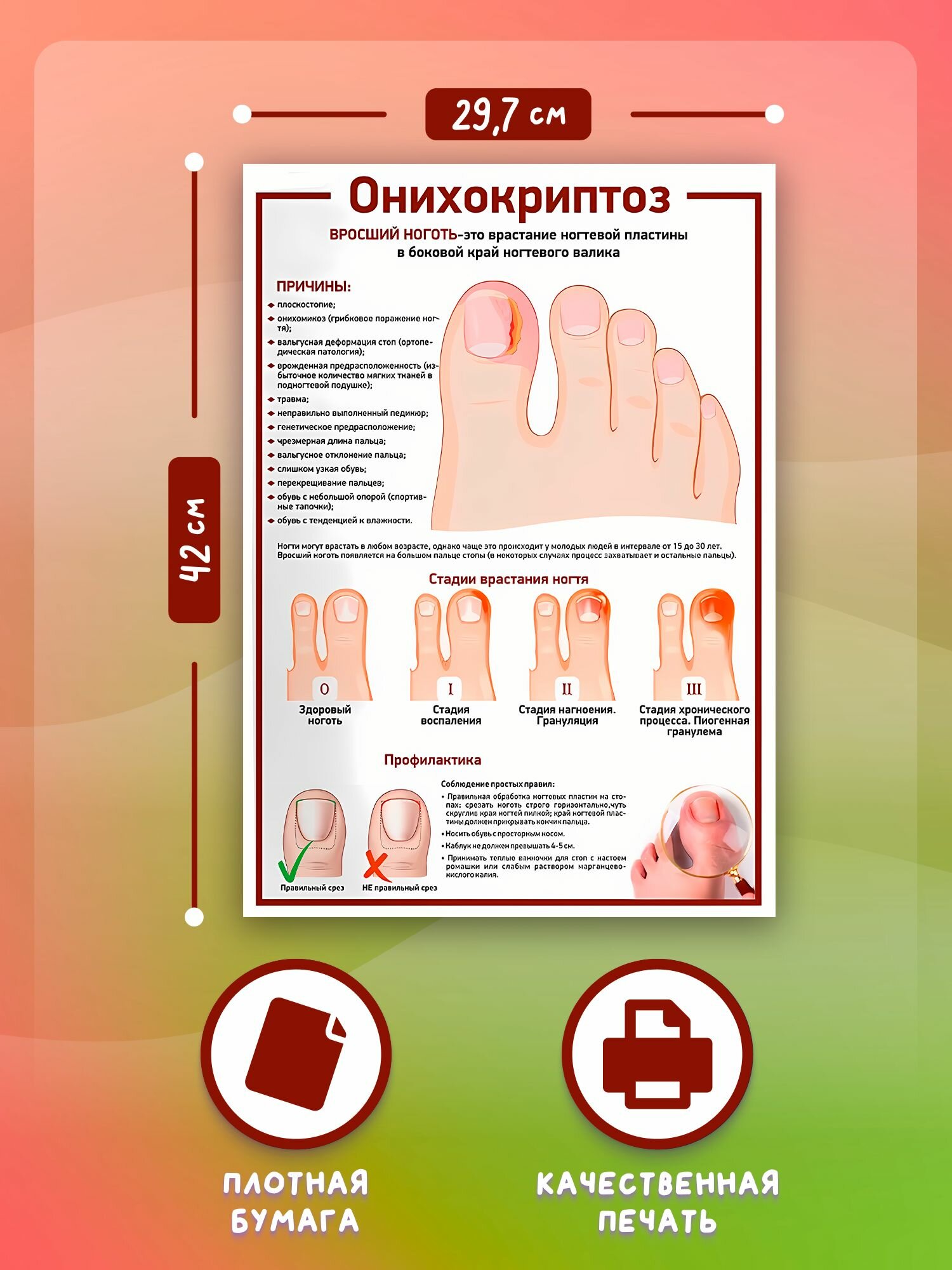 Постеры обучающие для подолога Онихокриптоз