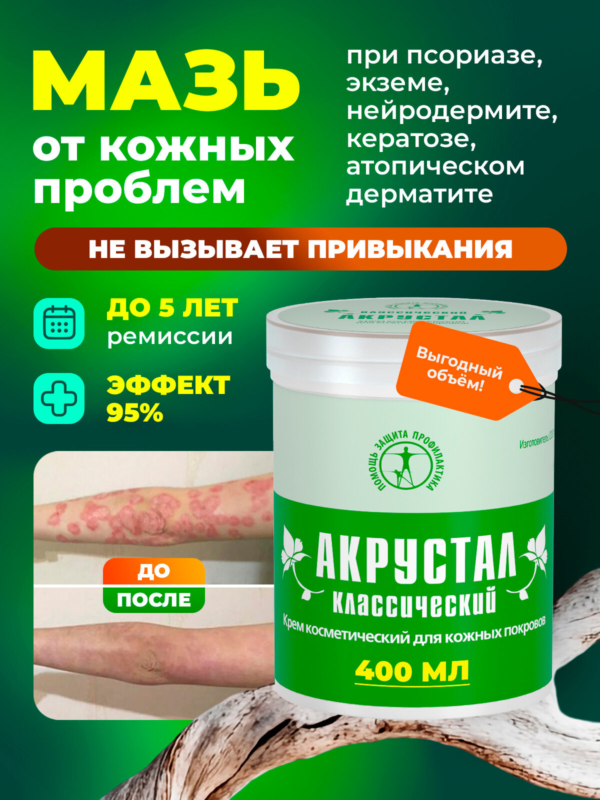Крем мазь от псориаза экземы и дерматита