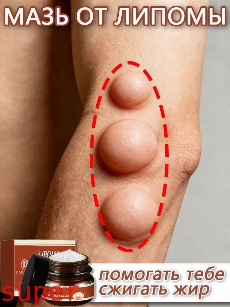 Мазь от липомы, 30 г, быстро удаляет подкожные жировые опухоли, подходит для лечения отеков кожи, целлюлита и фиброзных липом, быстро удаляет подкожные жировые опухоли.