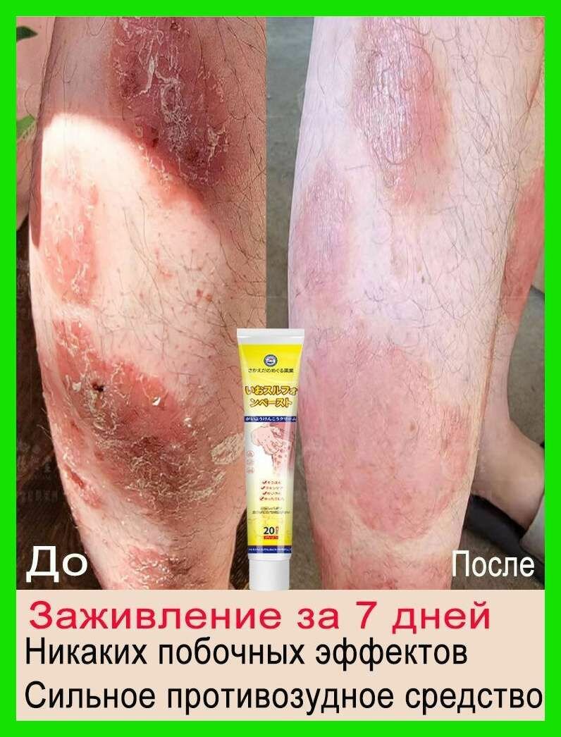 Тело крем от псориаза Противозудное, антибактериальное средство при экземе и герпесе