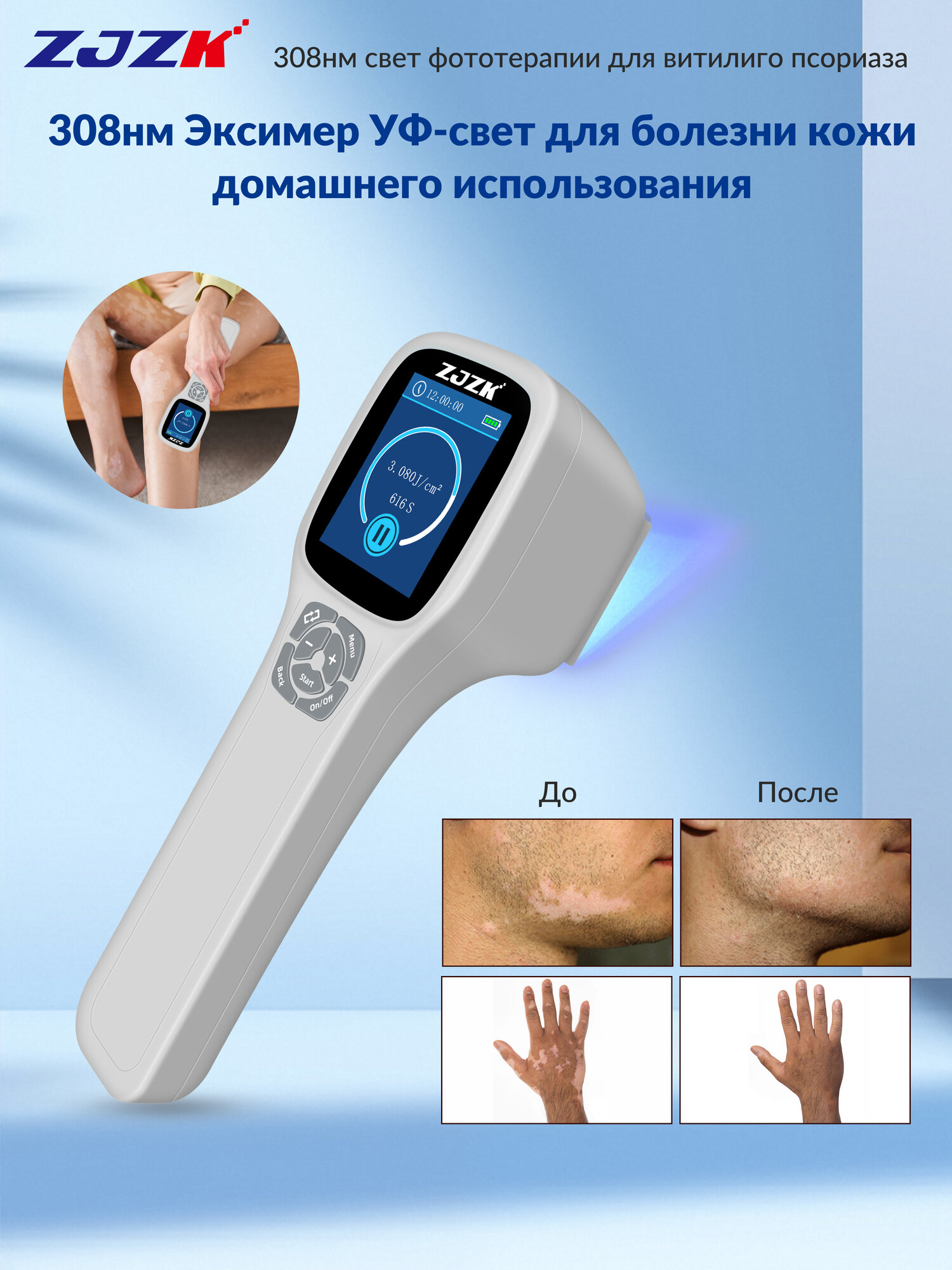 UVB лампа 308 нм с 64 диодами для фототерапии псориаза — безопасное домашнее лечение кожи.