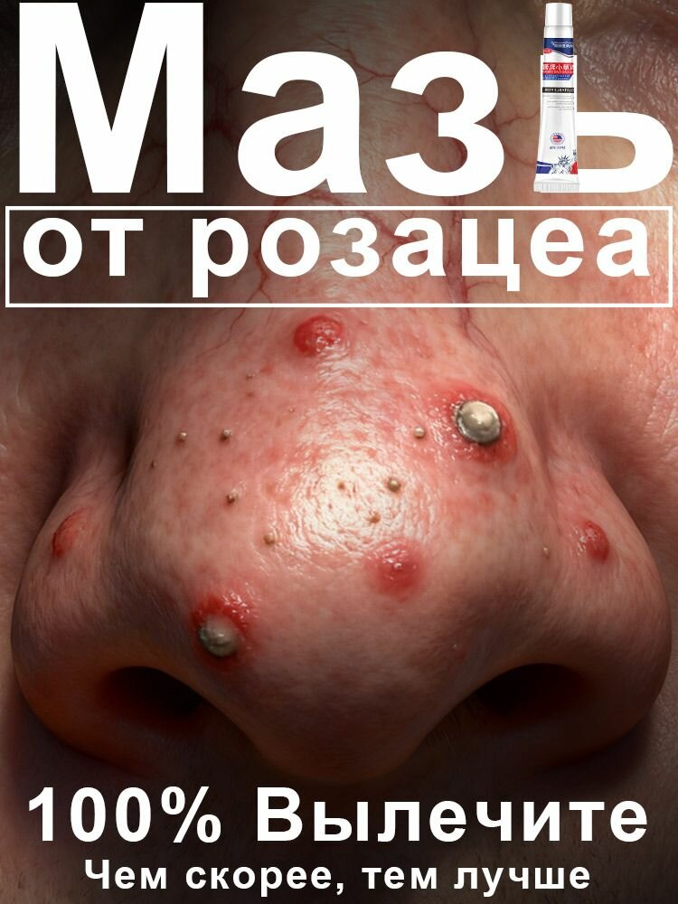 Мазь от розацеа/20 мл, Мазь от розацеа на лице купероза и покраснений, Китайская чудо-мазь для лечения розацеа уменьшает покраснение и припухлость носа, гиперемию и жирность кожи