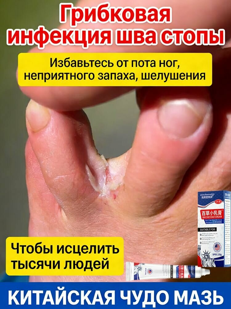 Крем от шелушения между пальцами ног антигрибковый, натуральный состав