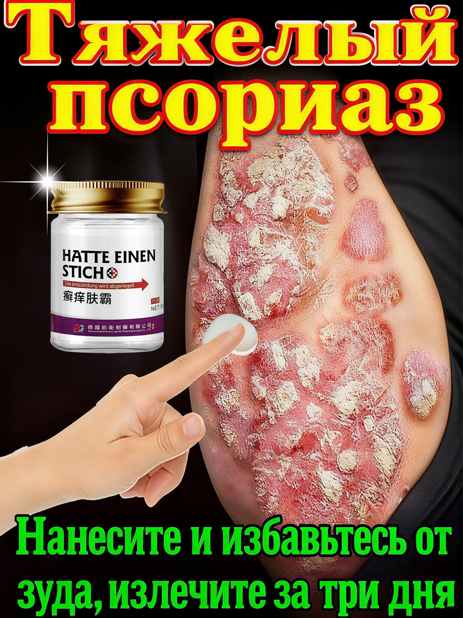 Крем от псориаза, от акне, крем для тела, от экземы, от дерматита, мазь от псориаза / 50 г.