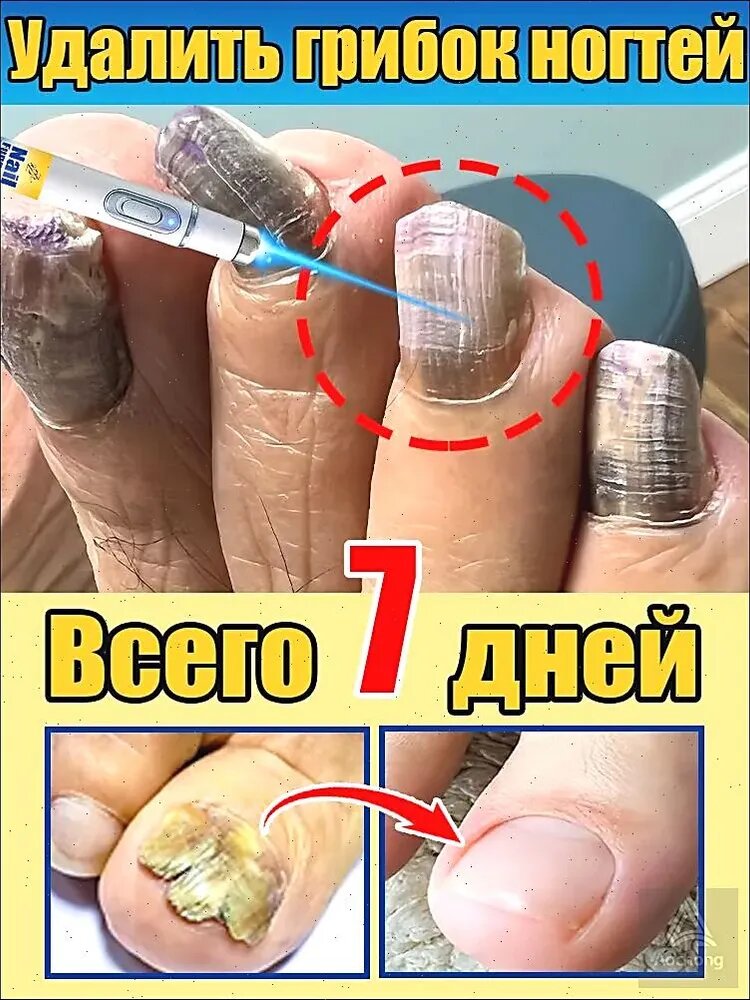 Лазерное лечение грибка ногтей позволяет устранить утолщение, отек и шелушение ногтей, стимулировать их рост и укрепление, а также обеспечить уход за ногтями.