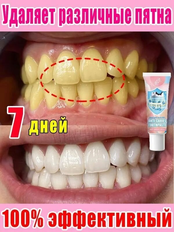 Отбеливающая и противокариесная зубная паста, используется для профилактики кариеса, укрепления зубной эмали, удаления зубного камня и налета, отбеливания зубов и защиты десен, 60 мл