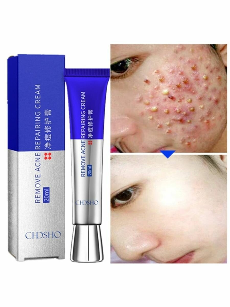 Крем-гель для лица и тела от черных точек, прыщей, постакне для наружного применения 30 г.