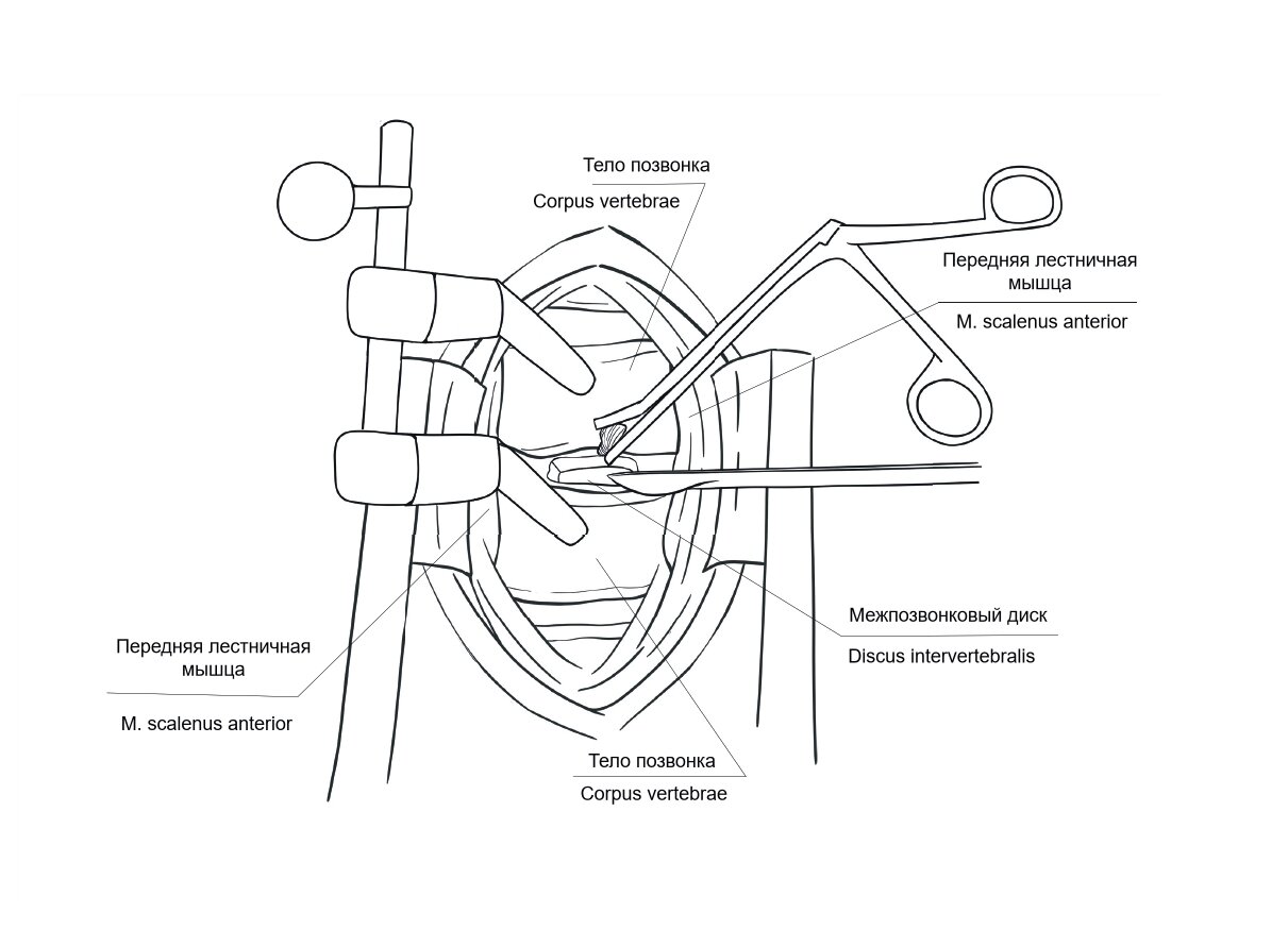 Атлас-раскраска доступов к шейному отделу позвоночника