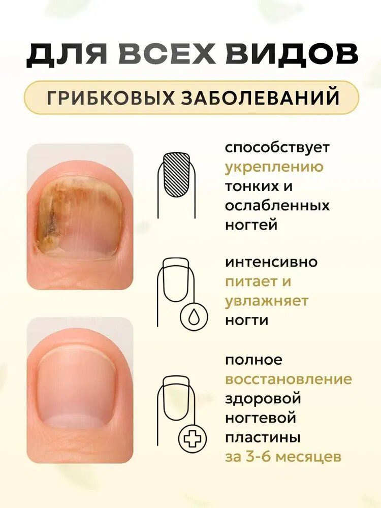 Средство от грибка ногтей на ногах, стоп онихолизис, 5мл. Средства для маникюра или педикюра: масло косметическое для ногтей, 5 мл, торговой марки Доктор Цынь.