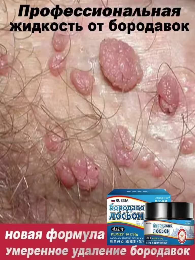 Папилофаг, Крем от папиллом и бородавок, средство для удаления новообразований, чистотел, Китайская травяная мазь, отсутствие побочных эффектов 30г