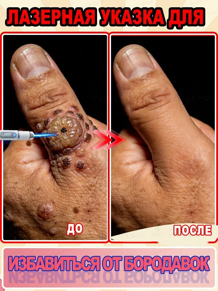 Лазерное удаление бородавок. С его помощью можно удалять различные бородавки, родинки, папилломы и остроконечные кондиломы. Безопасно, без шрамов, боли и побочных эффектов.1 ручка.