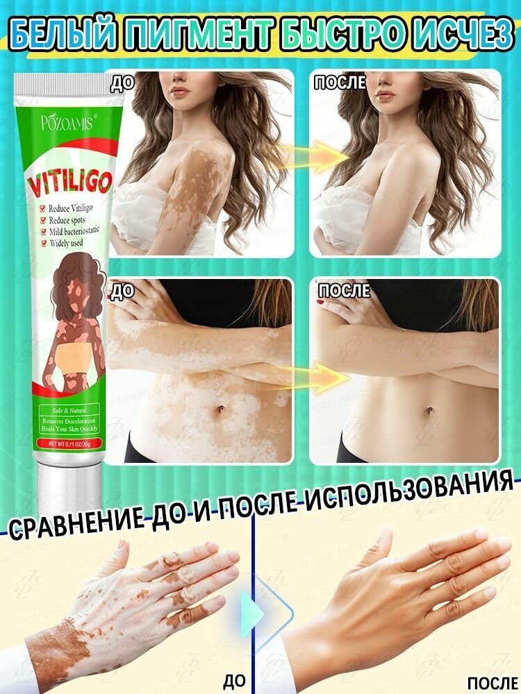 Мазь от пигментации. Используется для устранения белых пятен на коже. Быстро восстанавливает пигмент. Выравнивает тон кожи. Подходит для всего тела. 20 г