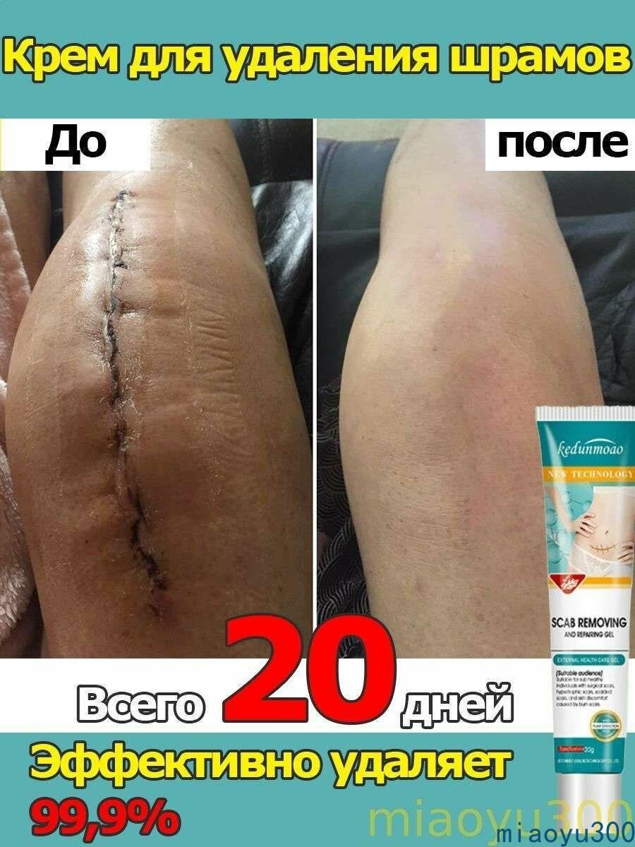 Крем от шрамов и рубцов Удаление шрамов после операций/ожоговых/гипертрофических/растяжек Содержит нано-серебро, флавоноиды глицирризы, натрия гиалуронат, алоэ 20г