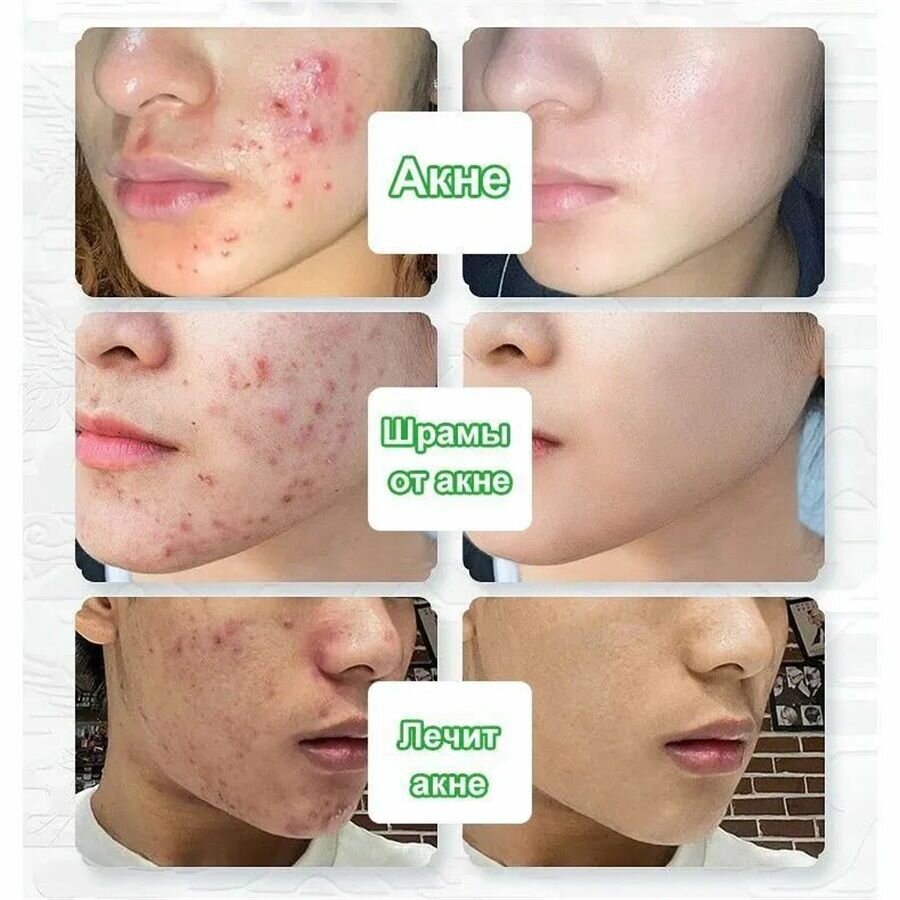 2 шт*30 г Крем для лица от акне прыщей воспалений, постакне быстрое заживление , для наружного применения, для подростков и взрослых 30 г