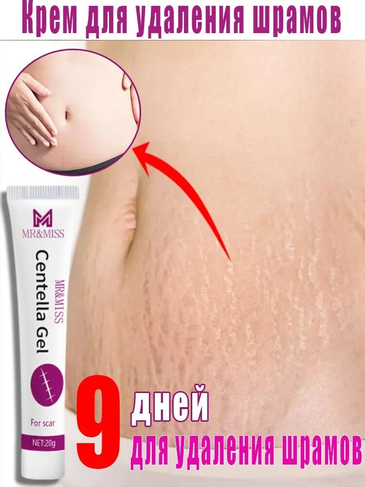 Крем от растяжек для беременных,10 мл