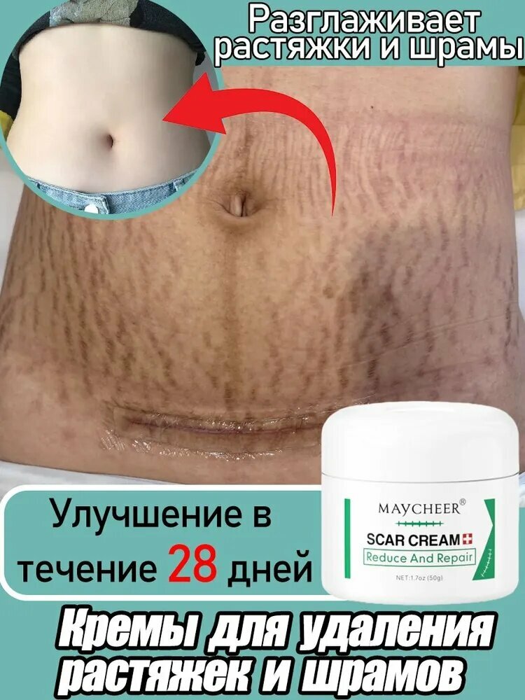 Средство от растяжек