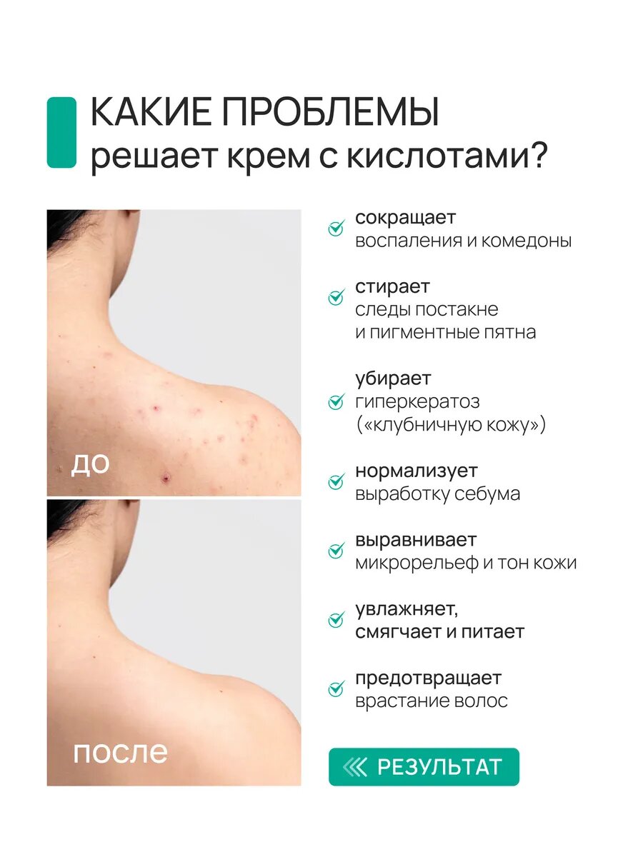 Крем для тела от прыщей с кислотами AHA+PHA 150 мл