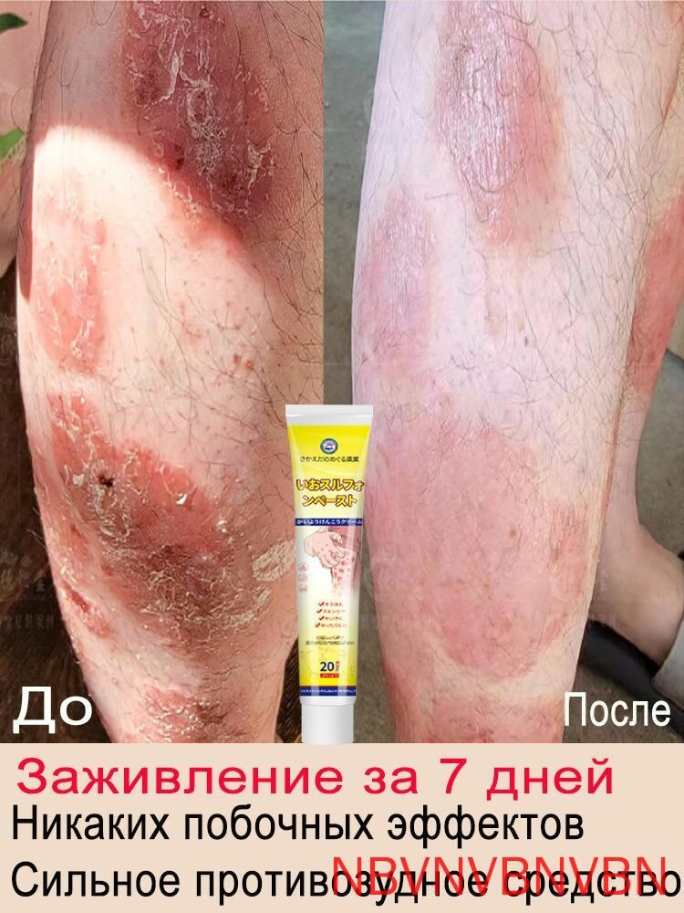 Тело крем от псориаза Противозудное, антибактериальное средство при экземе и герпесе