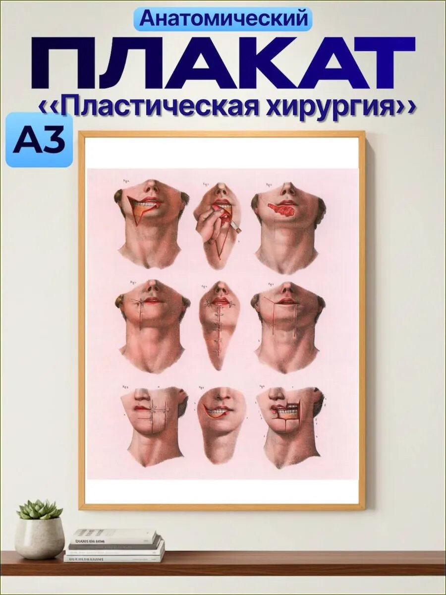 Постер медицинский, перфорант, пластическая хирургия, пластика, А3 анатомия, хирургия