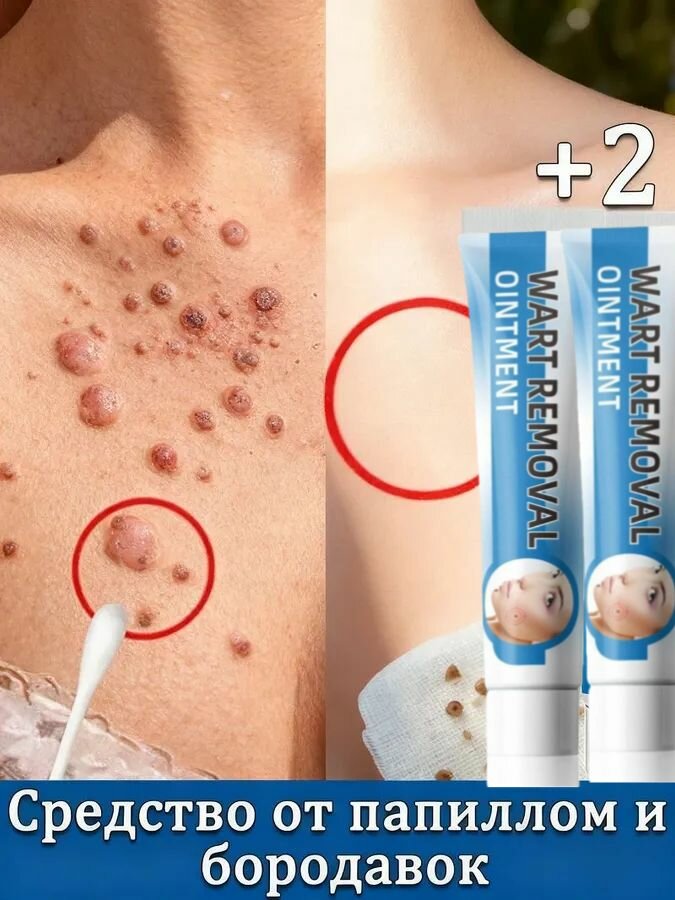 Крем средство для удаления бородавок, папиллом и родинок, безболезненно, не оставляет следов / 40г