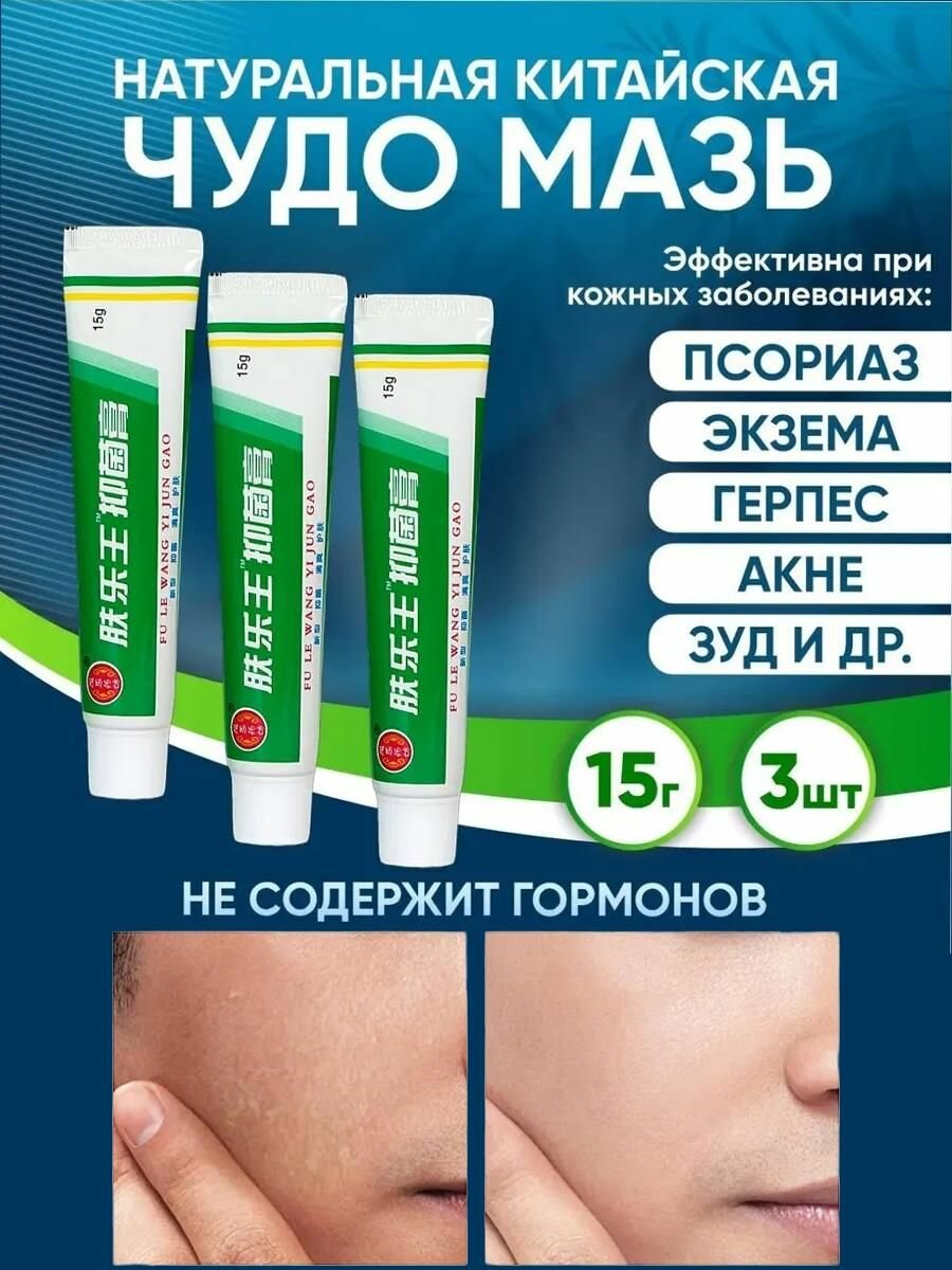 Китайская чудо мазь Ван Юэ от псориаза, экземы, дерматита, герпеса, акне