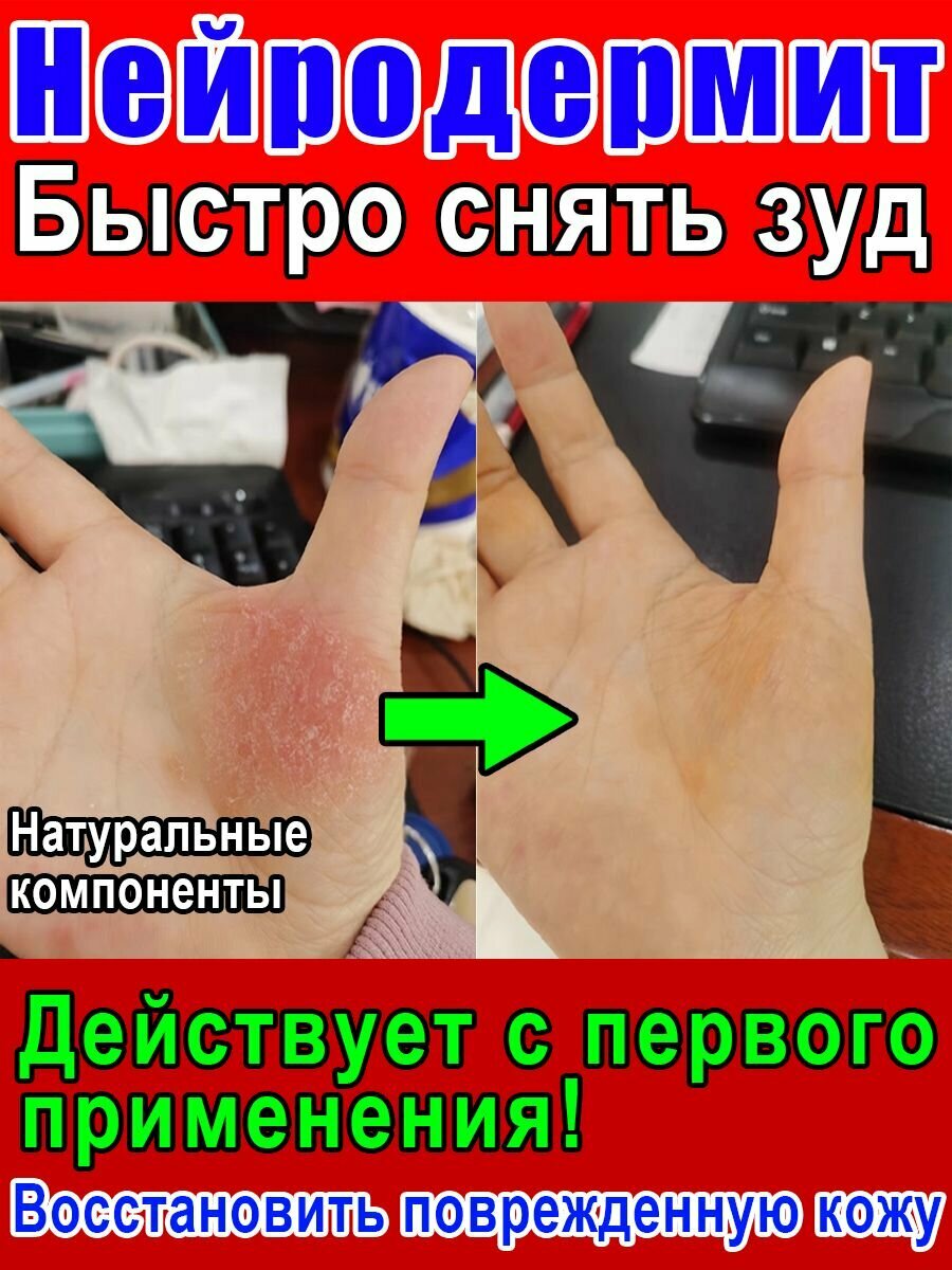 Мазь от нейродермита и дерматита