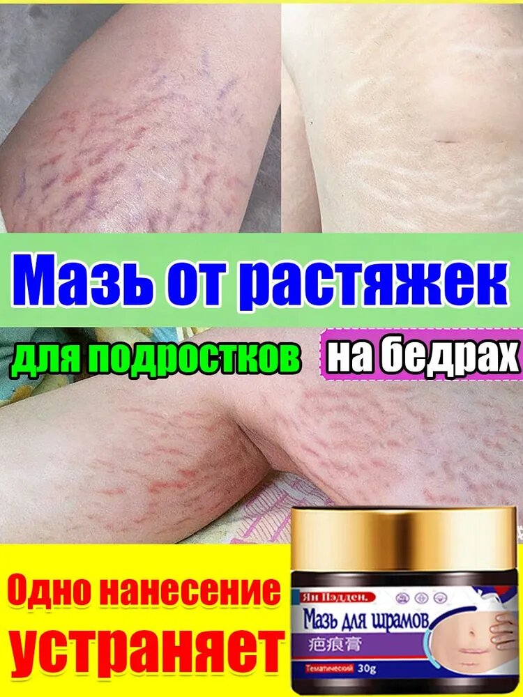 Мазь от растяжек на бедрах для подростков