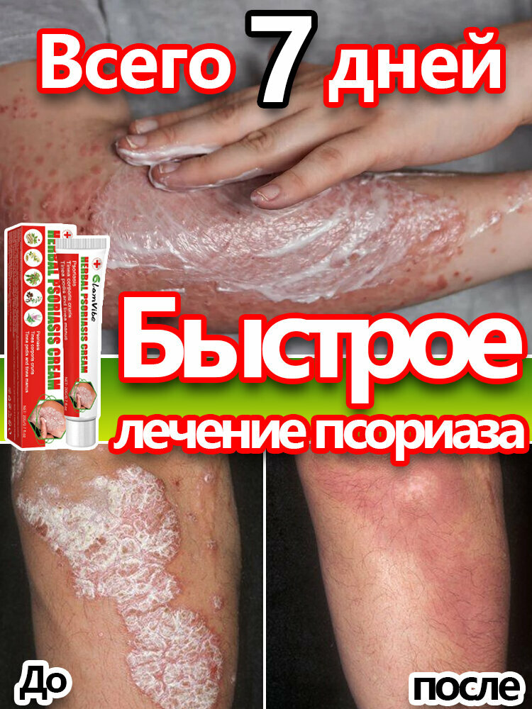 Крем от псориаза. Используется для лечения псориаза, грибковых инфекций, экземы, дерматита, опоясывающего лишая и акне; обеспечивает быстрое облегчение раздражения и покраснения кожи. 20 грамм.