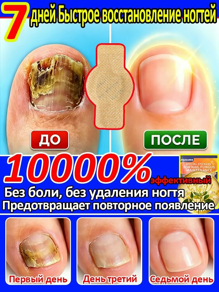 Антигрибковые наклейки для лечения ногтевого грибка, избавление от онихомикоза и воспаления паронихита, быстрое восстановление ногтевой пластины, снятие дискомфорта, удобное использование,105 шт