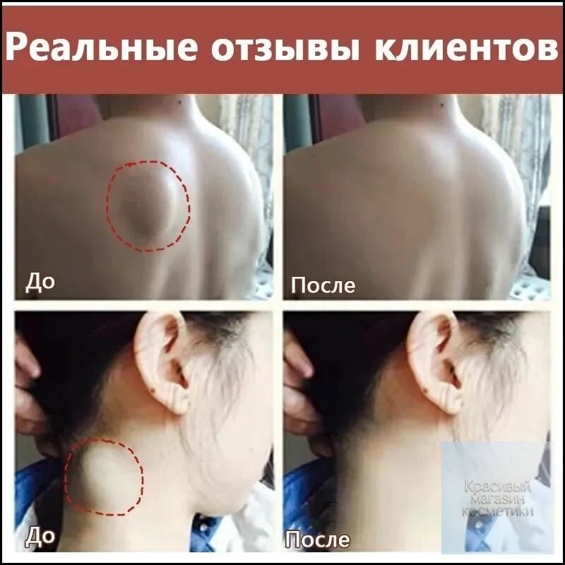 Натуральный крем для удаления липомы Быстро удаляет подкожную липому, показан при отечности кожи, целлюлите, фиброзном жировике, 30 г от липом от жировиков от целлюлита