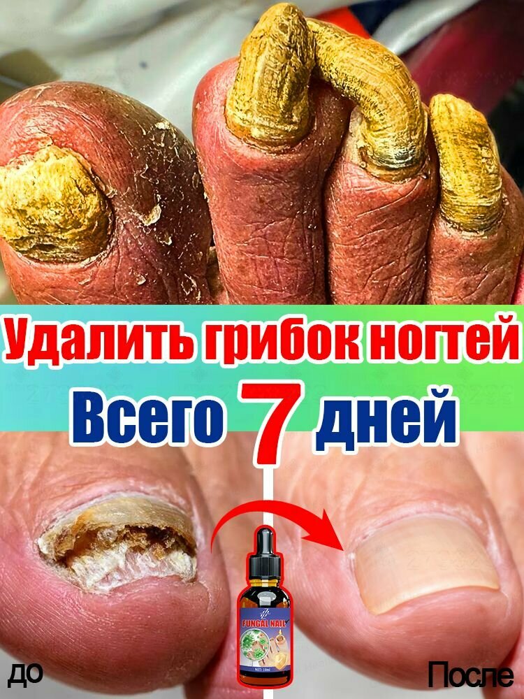 Быстрое лечение онихомикоза, подавление грибков, профилактика инфекций, подходит для лечения больных ногтей, паронихита, рогового слоя кожи. Безопасно и безболезненно.30 мл
