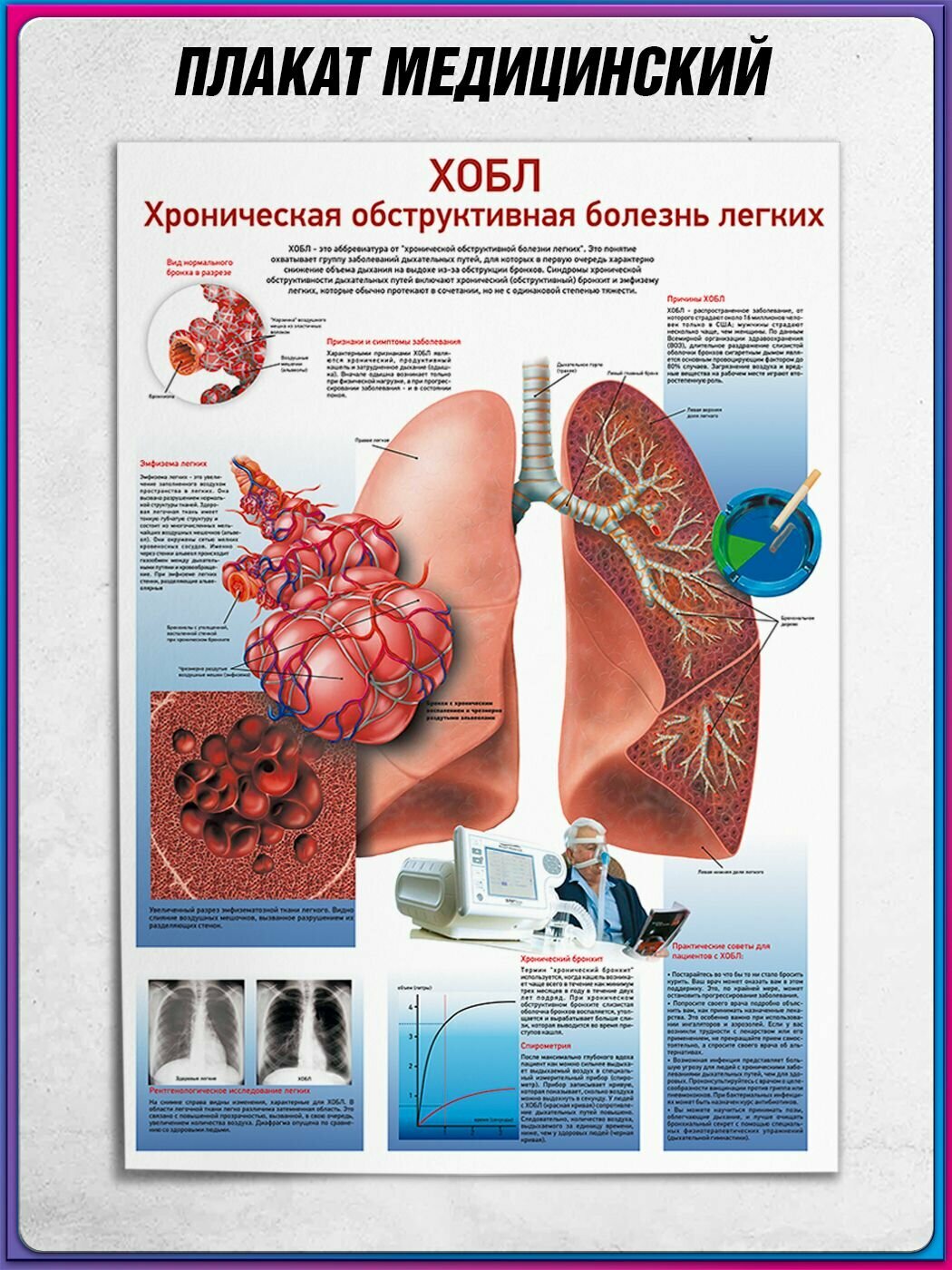 Информационный медицинский плакат "Хобл: Хроническая обструктивная болезнь легких" / ламинированный / Сити (120x180 см.)