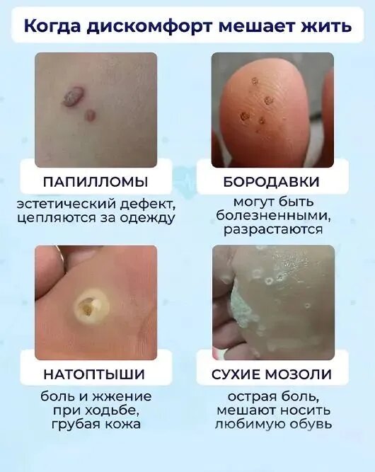 Крем от сухих мозолей стержневых, бородавок, натоптышей, шипиц и пяточных шпор, колломак от бородавок и папиллом, колломак средство от мозолей стержневых на ногах