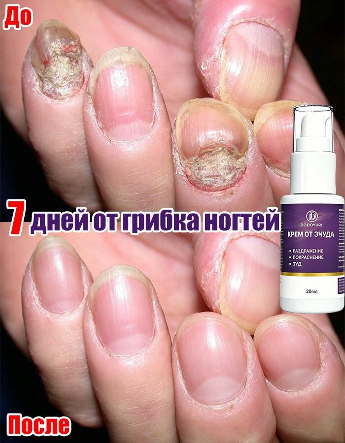 Мазь от грибка ногтей на ногах противогрибковый крем / мазь от грибка ног, мазь от зуда, микозе, онихолизис 20 мл