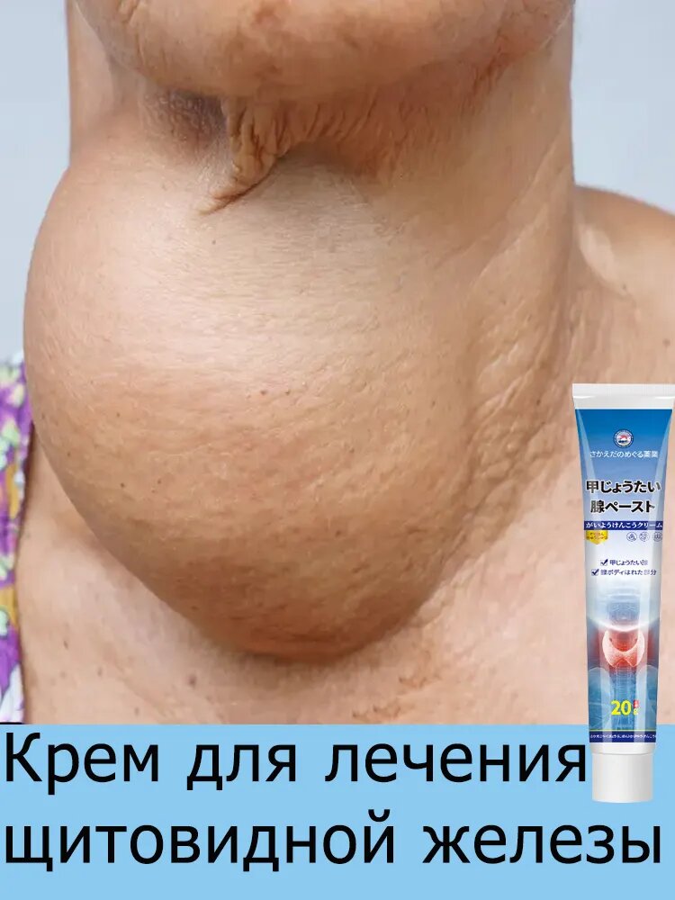 Мазь для лечения узлов щитовидной железы Гипертиреоз , Снижение увеличения щитовидной железы Мазь для регулирования